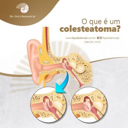 O que é um colesteatoma? – Dr. Fayez Bahmad
